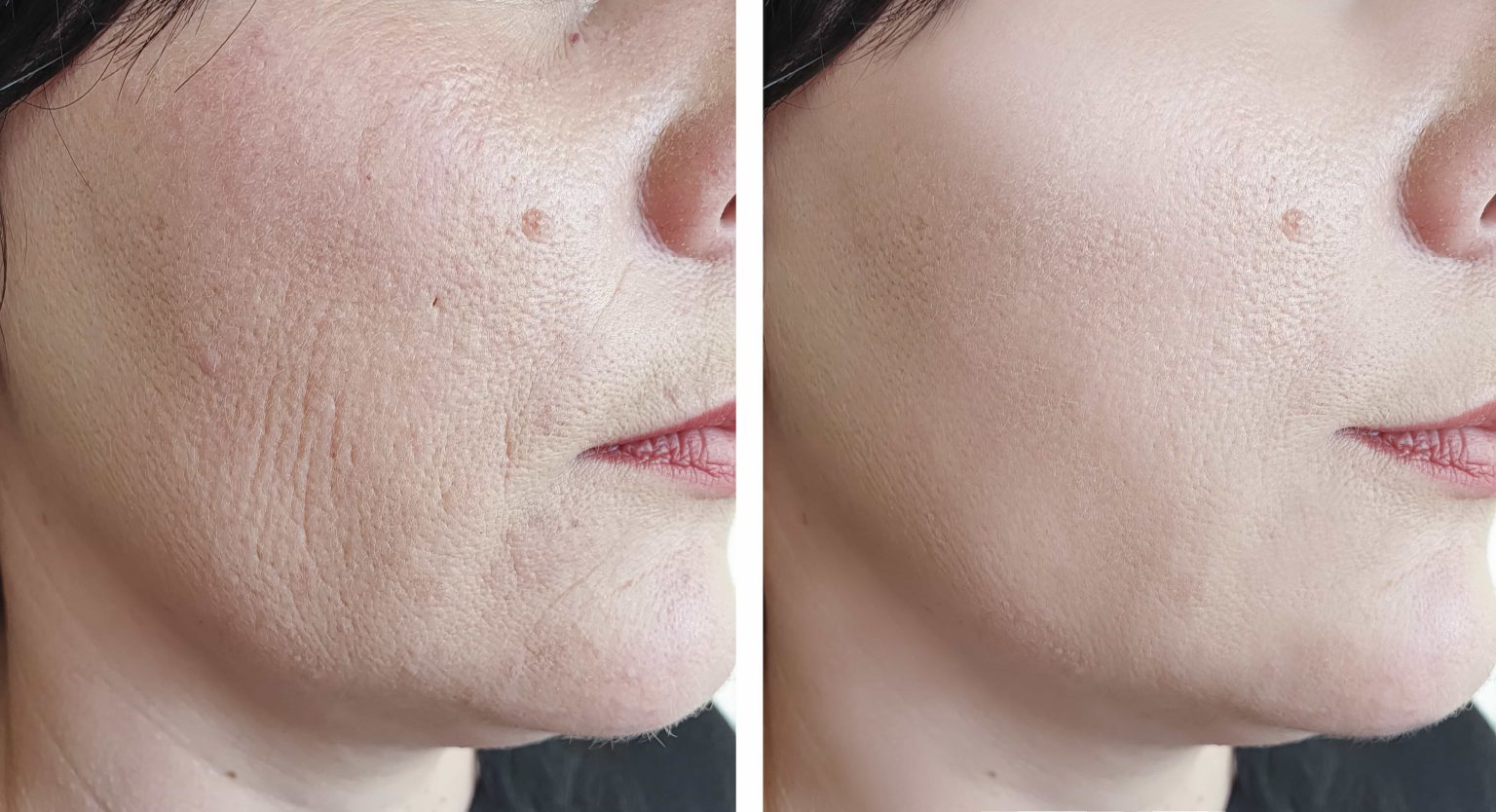 Frax 1550 Skin Resurfacing | Frax 1550 Laser Treatment Charlotte