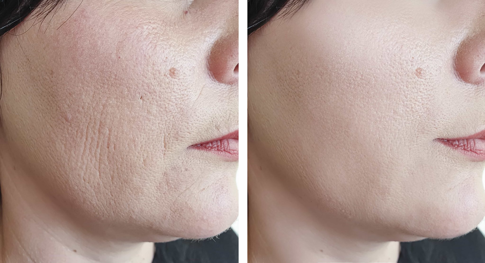 Frax 1550 Skin Resurfacing | Frax 1550 Laser Treatment Charlotte